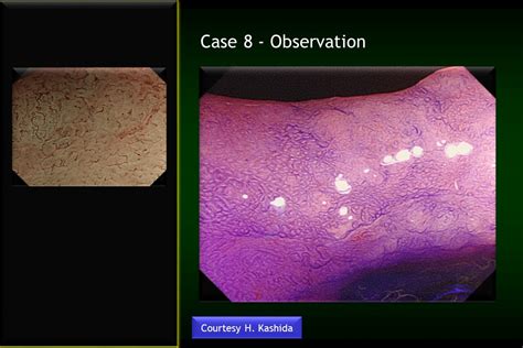 Pit Pattern Classification Colon Explorer