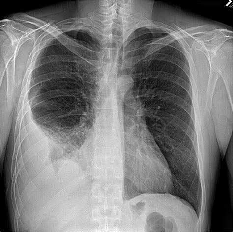 Pleural Effusion Diagnostic Approach In Adults Aafp