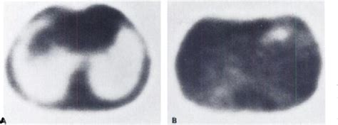 Figure 1 From Spect Liver Imaging Using An Iterative Attenuation Correction Algorithm And An