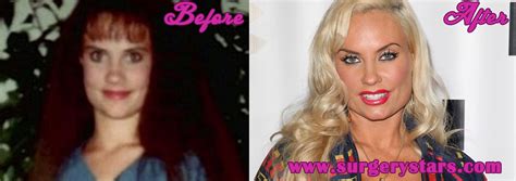 Coco Love Island Before Surgery At Isabel Yazzie Blog