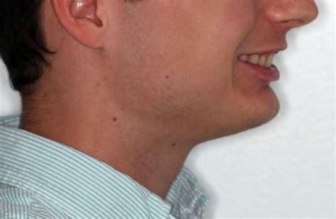 Deep Bite Before And After