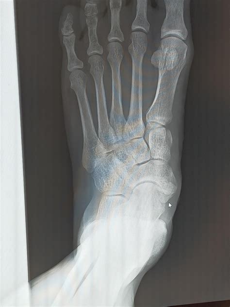 今日、整形外科の診察で 有痛性外脛骨と診 Hattomanさんのモーメント Yamap ヤマップ