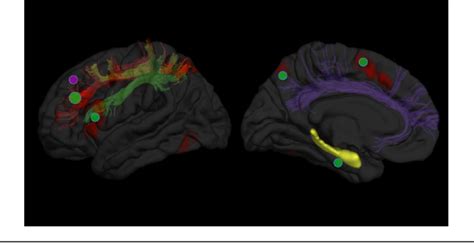 Functional Alterations To The Typical Working Memory Network Following Download Scientific