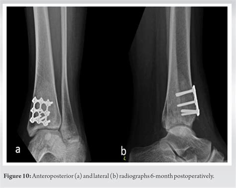 Joint Preserving Surgery For Idiopathic Bilateral Osteonecrosis Of The Distal Tibia A Case