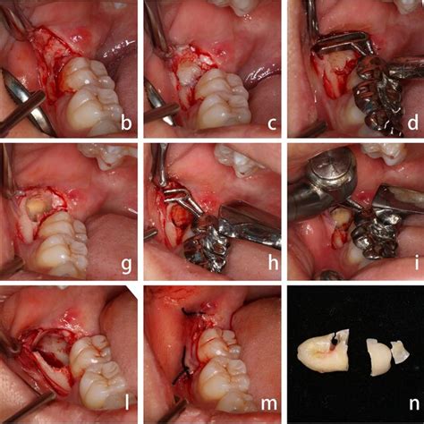Protocol For Template Surgery B Modified Triangular Flap Elevation To