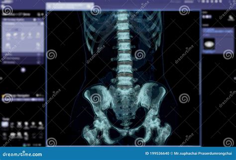 CT Scan Of Lumbar Spine 3D Rendering Showing Profile Human Spine Stock