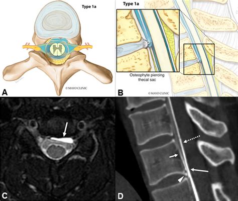 Dural Sac Tear Late Presentation Of Dural Tears Two Case Reports And