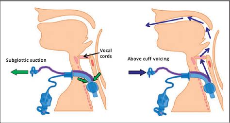 Figure From Above Cuff Vocalisation A Novel Technique For Communication In The Ventilator