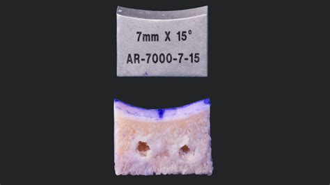 Arthrex Distal Tibia Allograft For The Treatment Of Glenoid Bone Loss