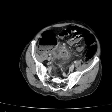 Radiopaedia Case Perforated Appendix Id 52351 Study 58247 NC Commons