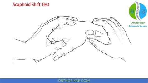 Watson Test Scaphoid Shift Test Explained Easily Orthofixar