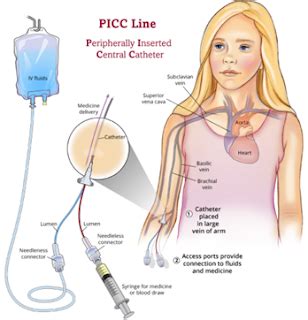 Ohima Blog Coding Peripherally Inserted Central Venous Catheter Picc