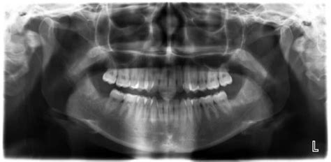 Suresmile Aligners And The Class I With Moderate Class Iii Pattern