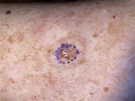 Melanoma Stock Image C060 3498 Science Photo Library