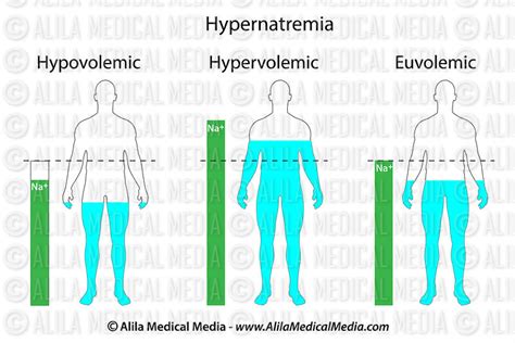 Alila Medical Media Types Of Hypernatremia Medical Illustration