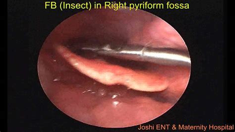 Piriform Fossa Piriform Fossa Piriform Recess