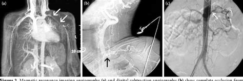 Figure 1 From A Takayasus Arteritis Case With Unilateral Digital Clubbing Semantic Scholar