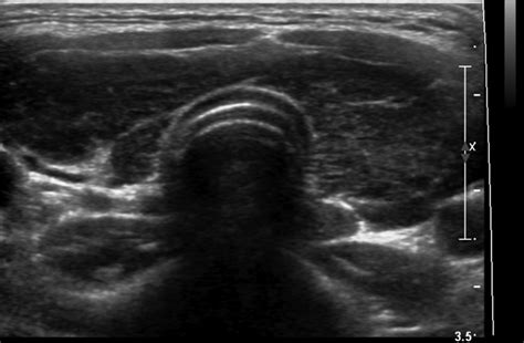 Ultrasonography Of The Thyroid Heterogeneously Low Echo Texture At