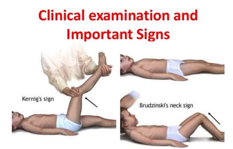 Clinical Examination And Important Signs Of Meningitis Meningitis Is A