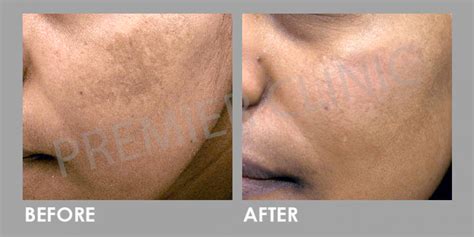 Pico Laser Treatment Acne Scar Tattoo Premier Clinic KL Malaysia