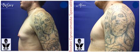 Gynecomastia Surgery Before And After See Real Results