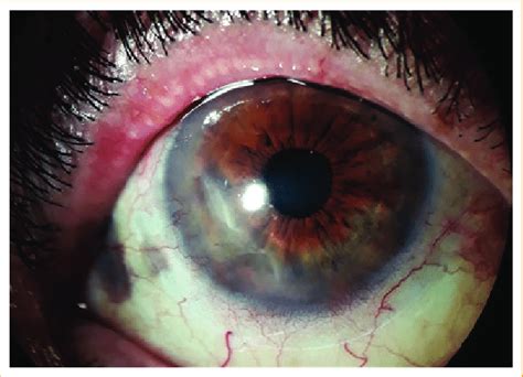 Several Areas Of Scleral Thinning And A Large Area Of Corneal Thinning