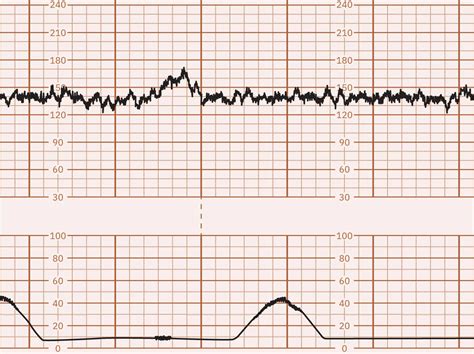 16 1 Basic Terms Of Fetal Heart Rate And Contraction Patterns