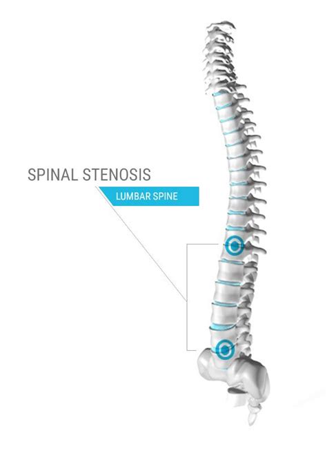 What Is Spinal Stenosis Tampa Spinal Stenosis Treatment