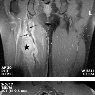Magnetic Resonance Images Of A Patient With A Partial Proximal Download Scientific Diagram