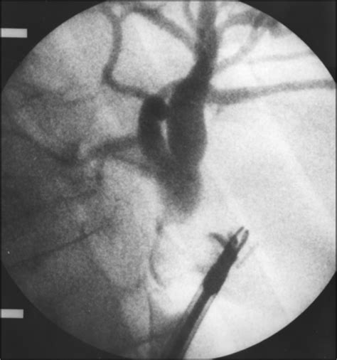 This Laparoscopic Ioc Shows Incomplete Obstruction At The Common Bile