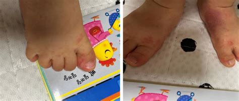 아기 수족구 증상 열 입안 수포 발진 설사 40도 고열 전염성 및 치료기간 람람쥐