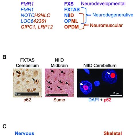 Cgg Repeat Expansions Cause A Spectrum Of Disease A Identical Cgg