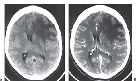 Pathology And Radiology Neupsy Key