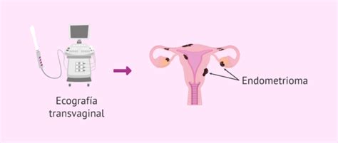 Diagnóstico De La Endometriosis Analíticas Y Pruebas De Imagen