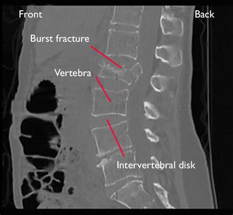 Fractures Of The Thoracic And Lumbar Spine Dr Mukhi S Raj Hospital