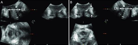 Multiplanar Mode Depicting Three Orthogonal Planes Of Normal Levator Download Scientific