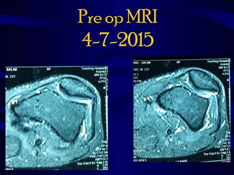 Lateral Patellar Compression Syndrome Ppt