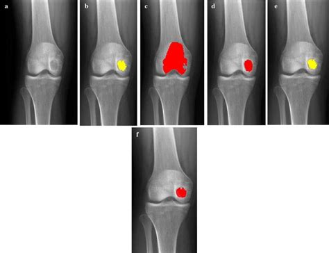 A Input Image B Fcm Segmented Image C Active Contour Segmented Image Download Scientific