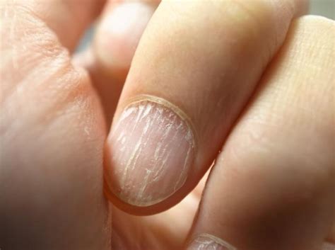 손톱끝이 갈라지는 이유 7가지 정리했어요 랑큐
