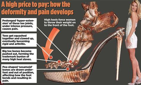 High Heels 3d Scan Shows Stilettos Cause Unsightly Clawed Toes