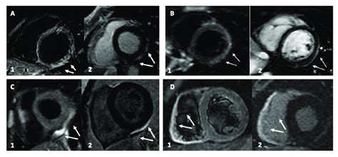 Cardiac Magnetic Resonance Cmr Imaging Of Young Patients With