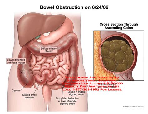 Bowel Obstruction