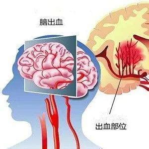 【脑健康日】 健康居家 让高血压病患者远离脑出血睡眠动脉症状