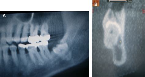 References In Partial Odontectomy Oral And Maxillofacial Surgery Clinics