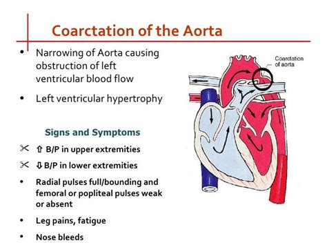 Coarctation Of The Aorta Diagram