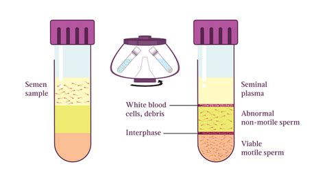 How Double Density Gradient Centrifugation Impacts Sperm Quality San Antonio News 360