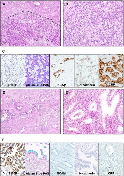Up To Date Pathologic Classification And Molecular Characteristics Of Intrahepatic