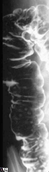 Colon Fx Aphtoid Ulcers Multiple Small Dx Crohns Disease Be The Common Vein