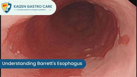 Barretts Esophagus Egd Barrett Esophagus Practice Essentials