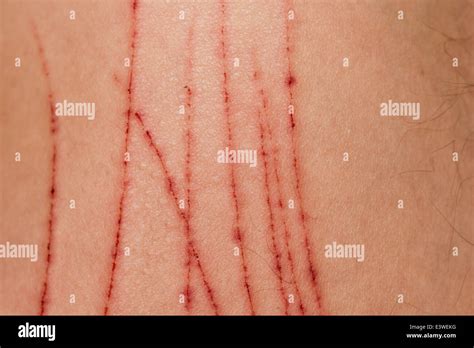 Scratch Marks On Skin